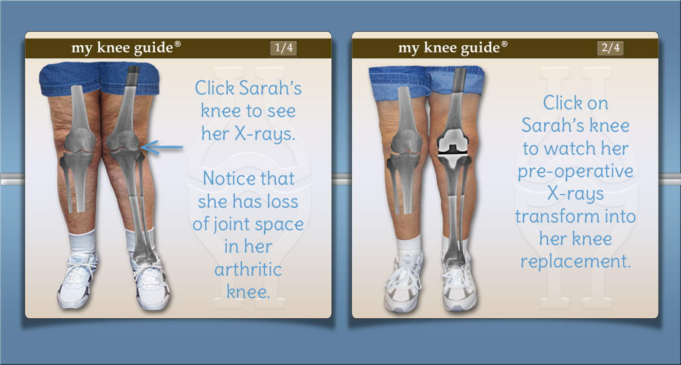 Sarah: Sarah can stand straight again after her surgery